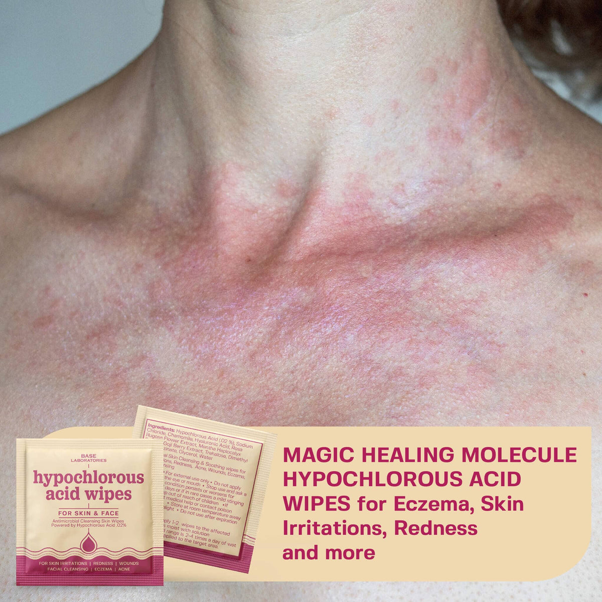 Hypochlorous Acid Wipes for Face & Skin - HOCL for Sensative Skin ...